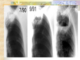 Dijagnostika na tuberkuloza | PPT