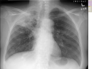 Dijagnostika na tuberkuloza | PPT