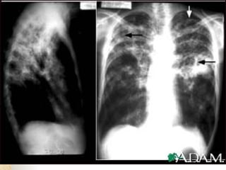 Dijagnostika na tuberkuloza | PPT