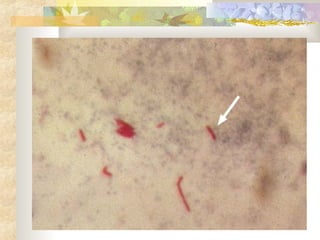 Dijagnostika na tuberkuloza | PPT