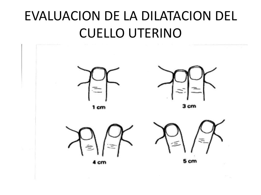 Dilatacion Cervical