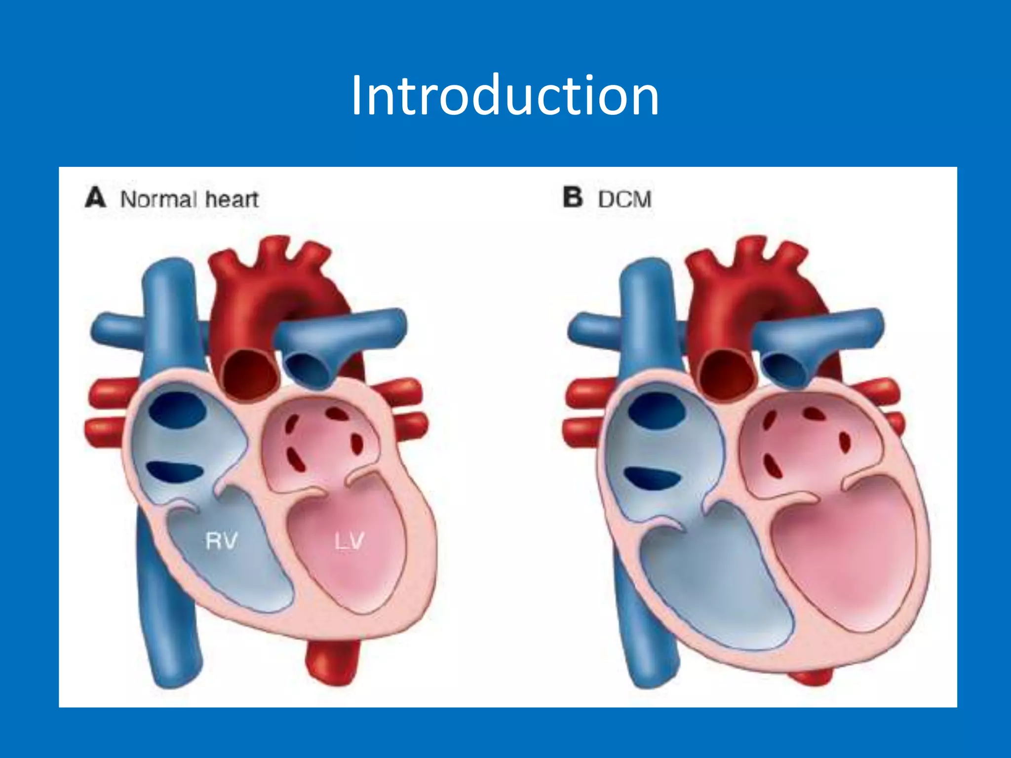 Dilated cardiomyopathy | PPTX