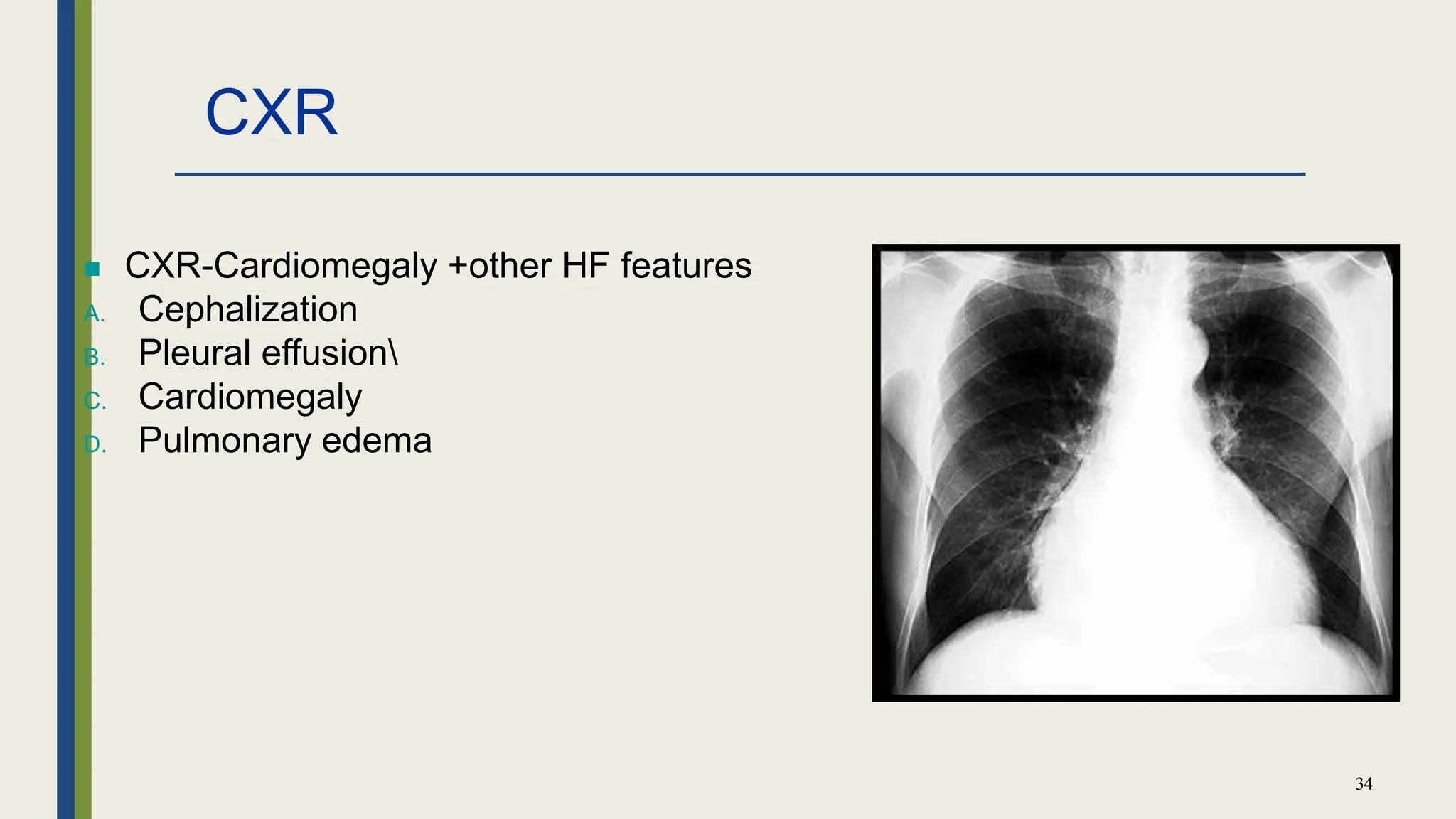 dilated cardiomyopathy.pptx