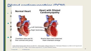 dilated cardiomyopathy.pptx