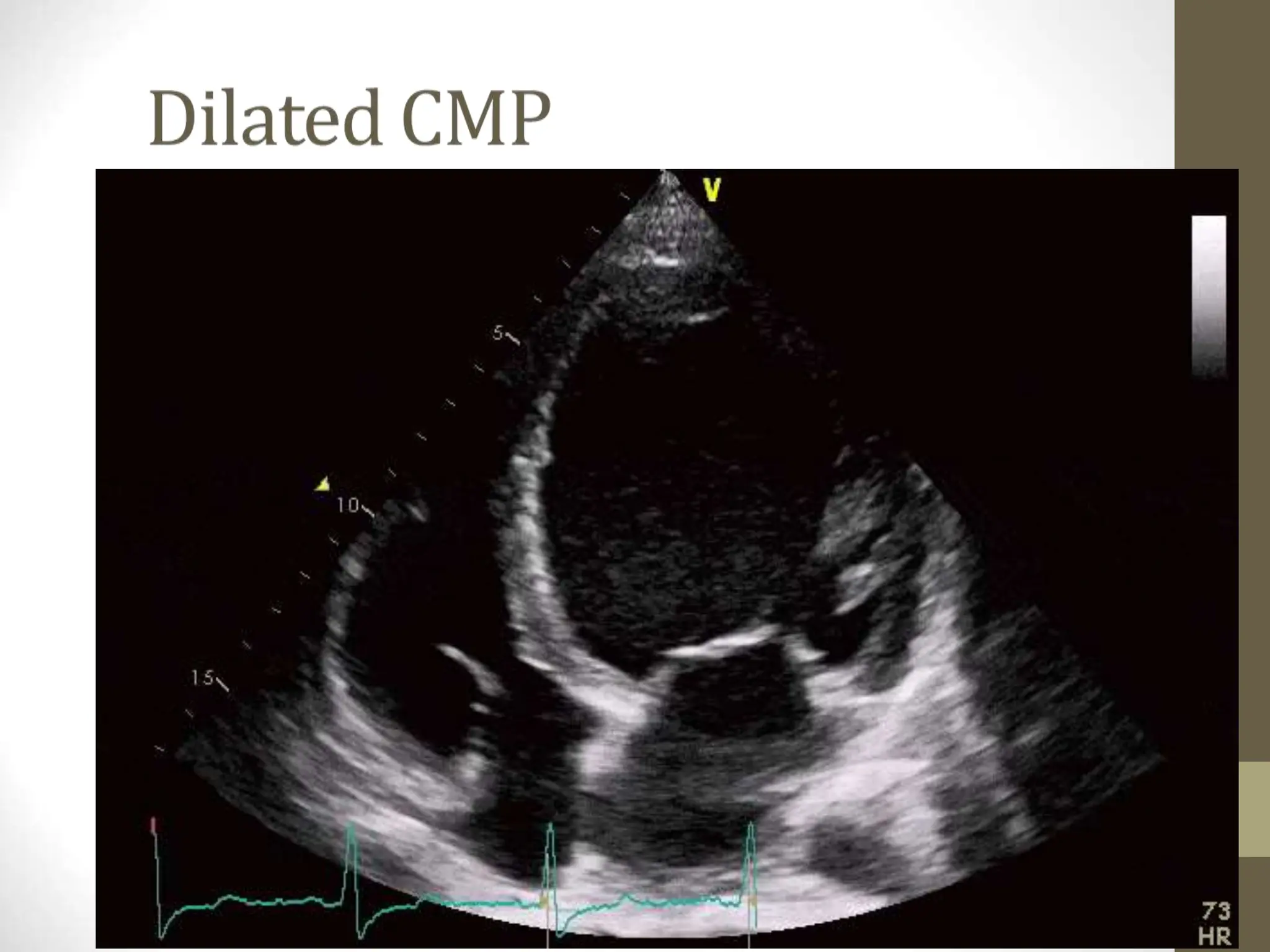 Dilated CMP case presentation and treatment .ppt