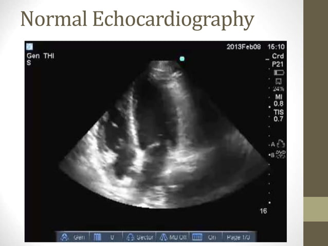 Dilated CMP case presentation and treatment .ppt