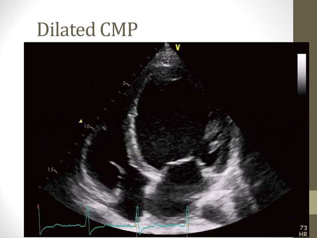 Dilated CMP case presentation and treatment .ppt