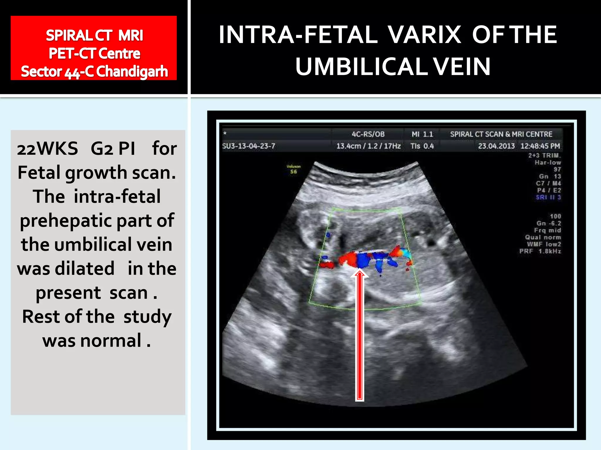 Dilated intra abdominal fetal umbilical vein | PPTX