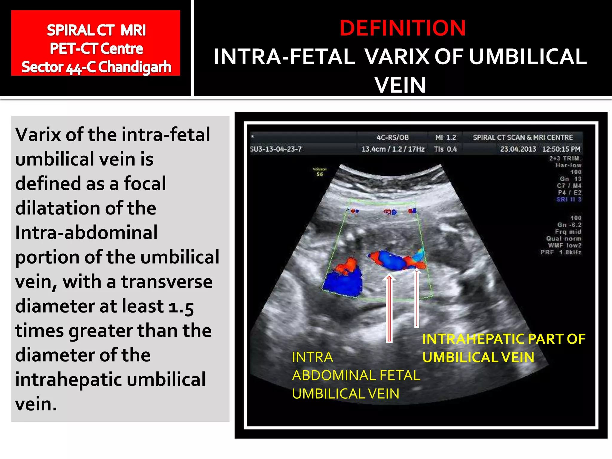 Dilated intra abdominal fetal umbilical vein | PPTX