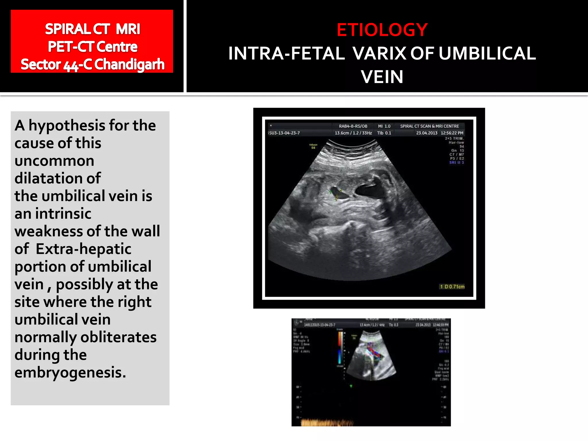 Dilated intra abdominal fetal umbilical vein | PPTX | Pregnancy ...