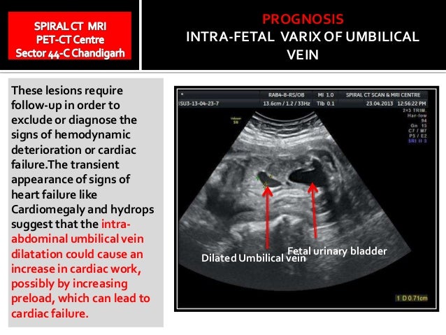 Dilated intra abdominal fetal umbilical vein