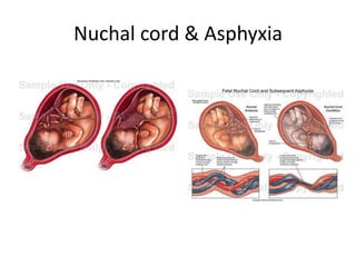 Dilemmas In The Management Of Nuchal Cord | PPTX | Pregnancy | Reproductive Health