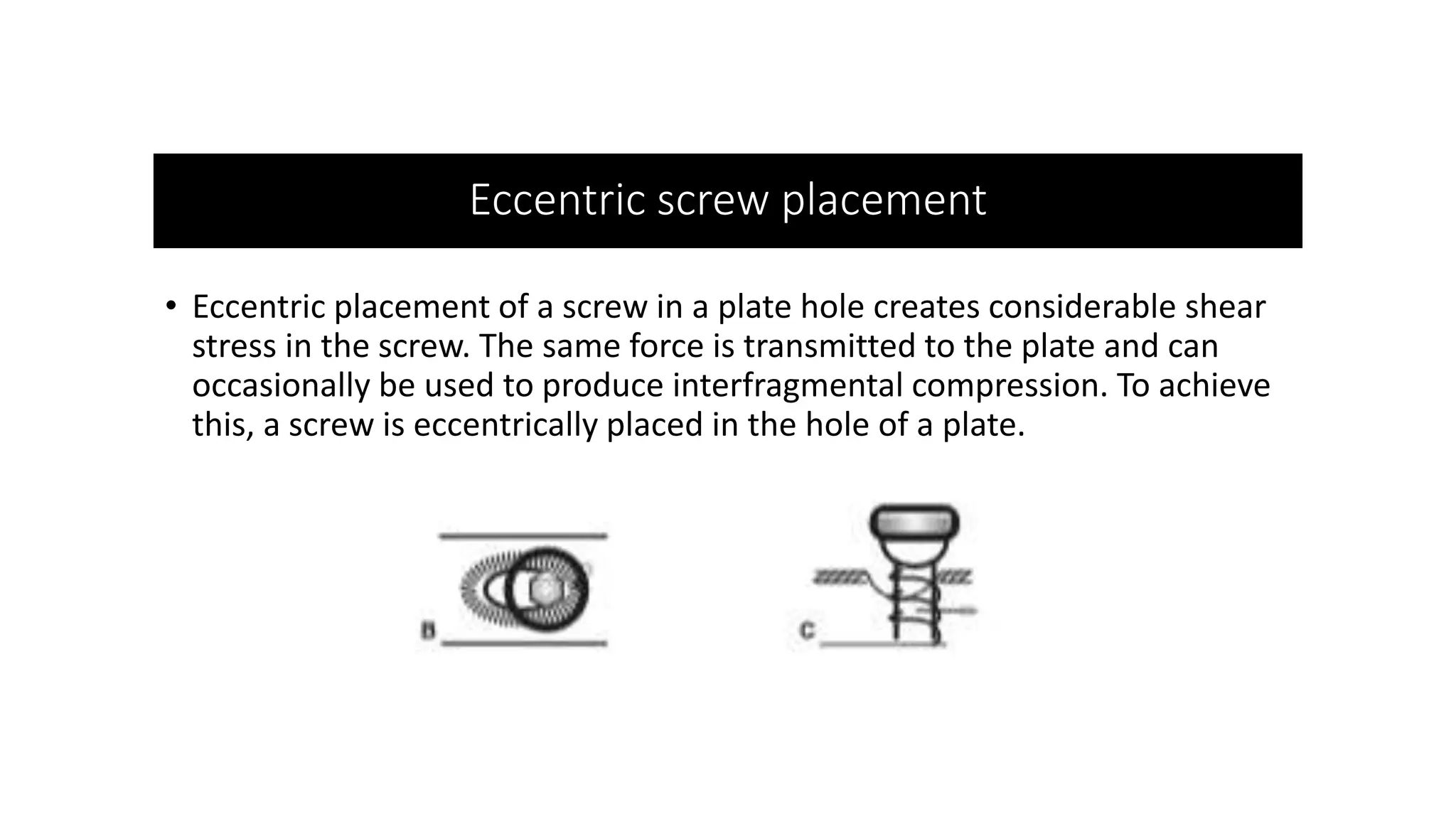 screws and plate | PPTX