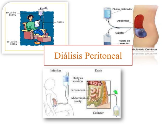 Diálisis peritoneal | PPTX