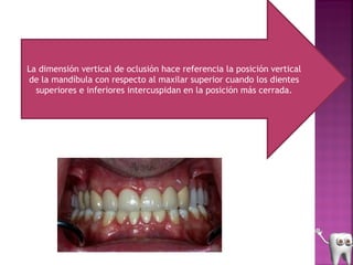 Dimension vertical oclusión | PPT