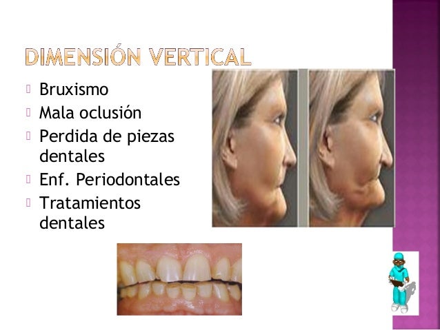 Dimension vertical oclusión