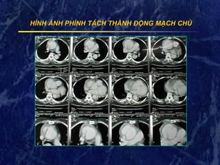 Dinh huynh-linh-xu-tri-dau-nguc | PDF