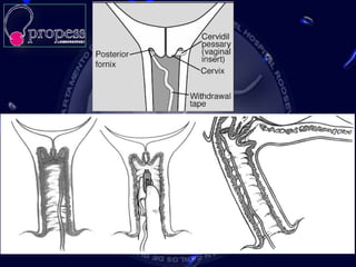 MADURACION CERVICAL CON DINOPROSTONA | PPTX