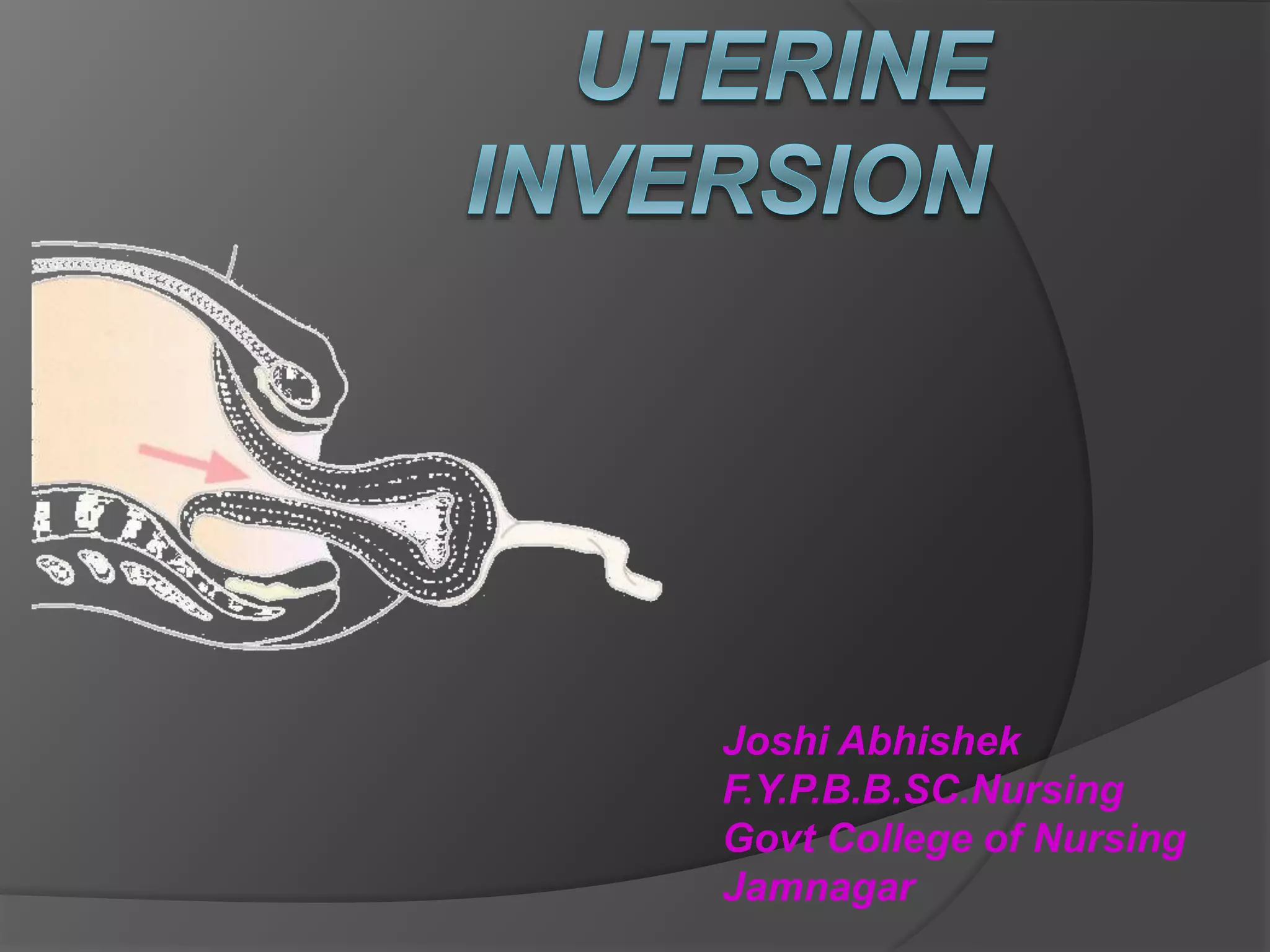 Inversion Of Uterus | PPTX