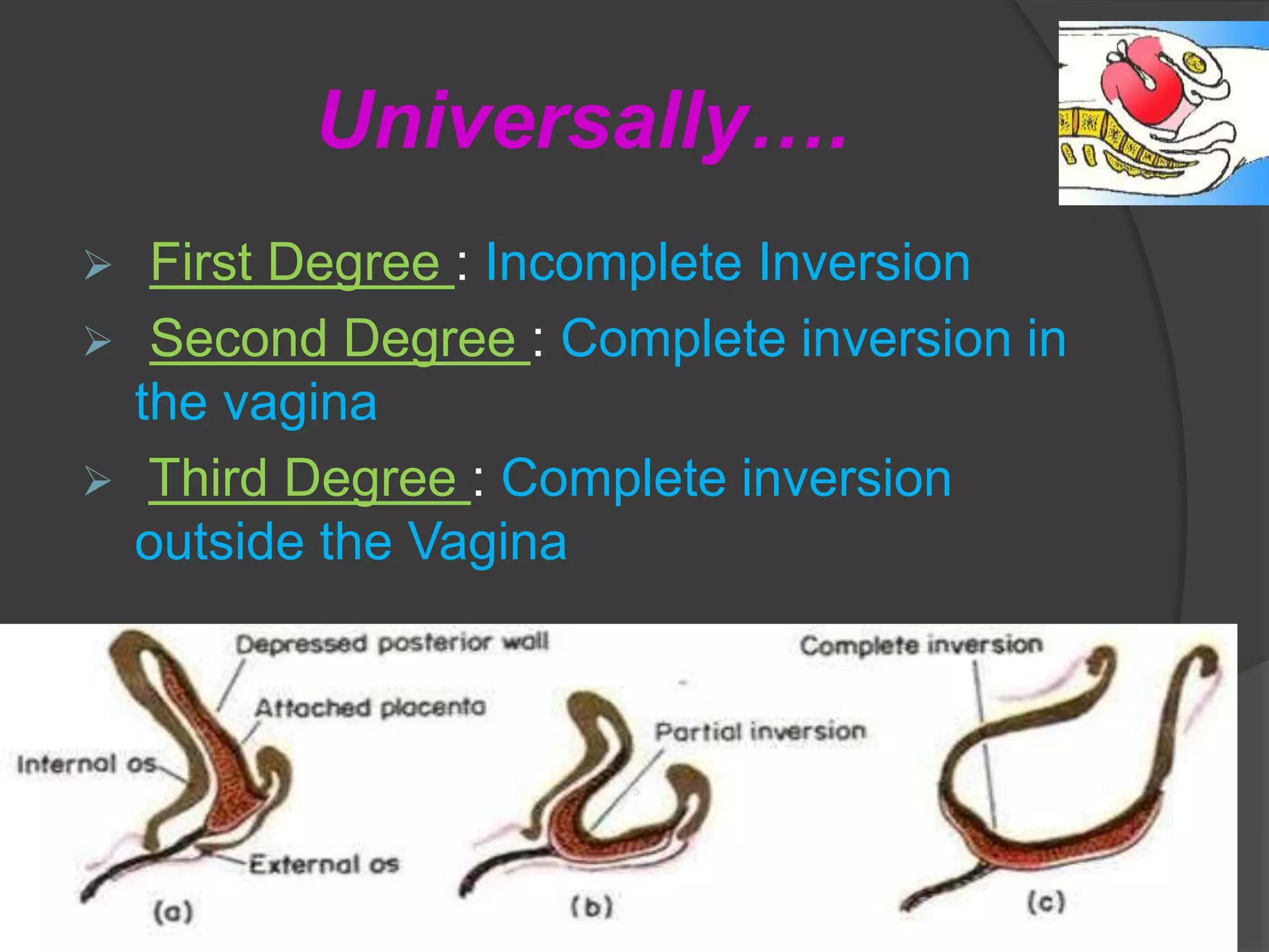 Inversion Of Uterus | PPTX
