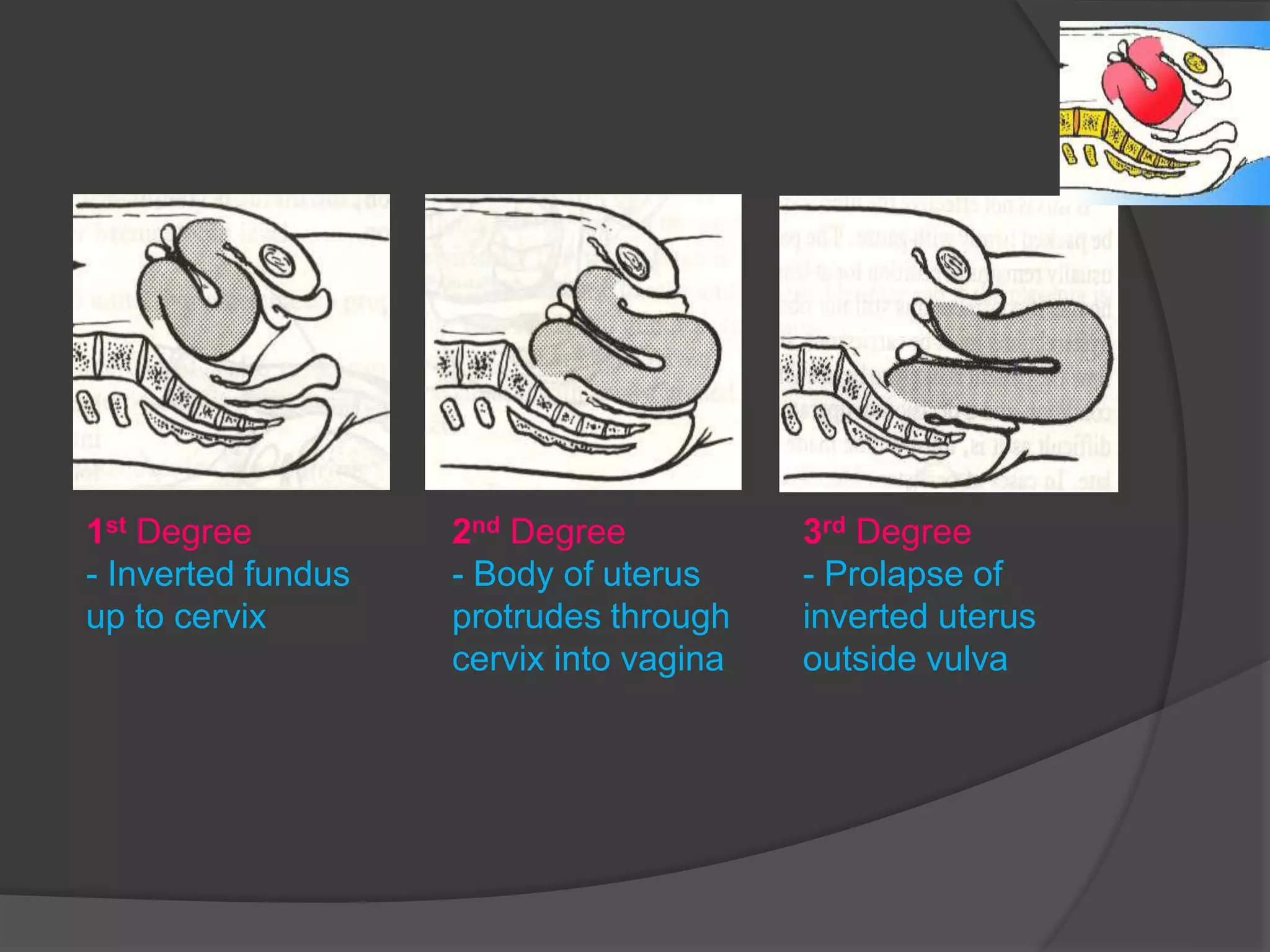Inversion Of Uterus | PPTX