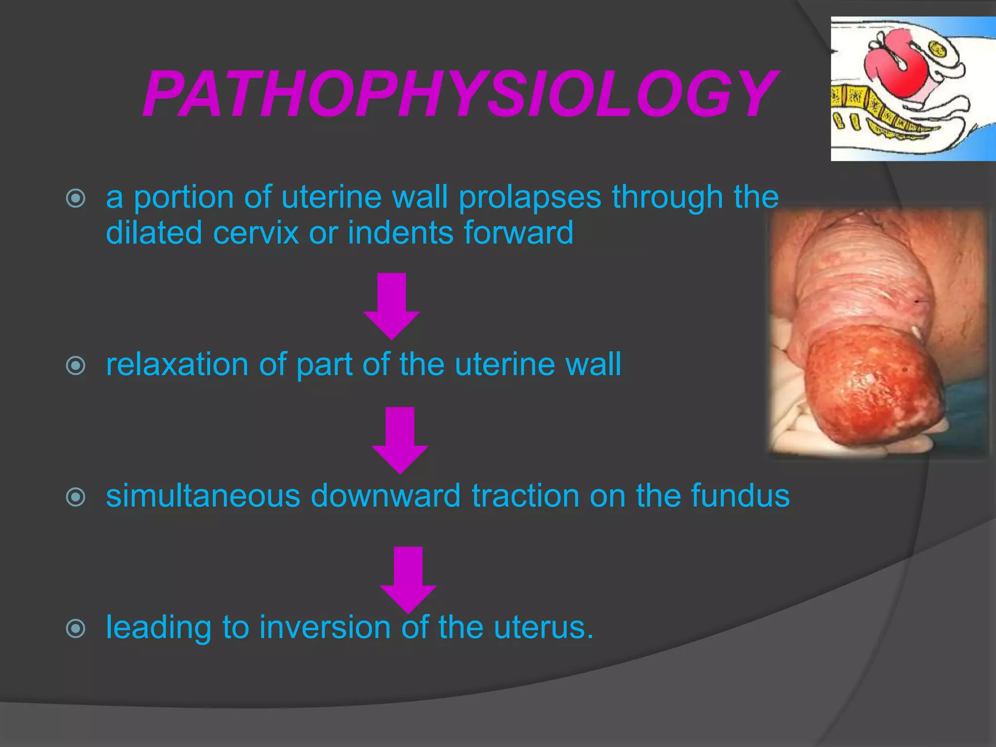 Inversion Of Uterus | PPTX