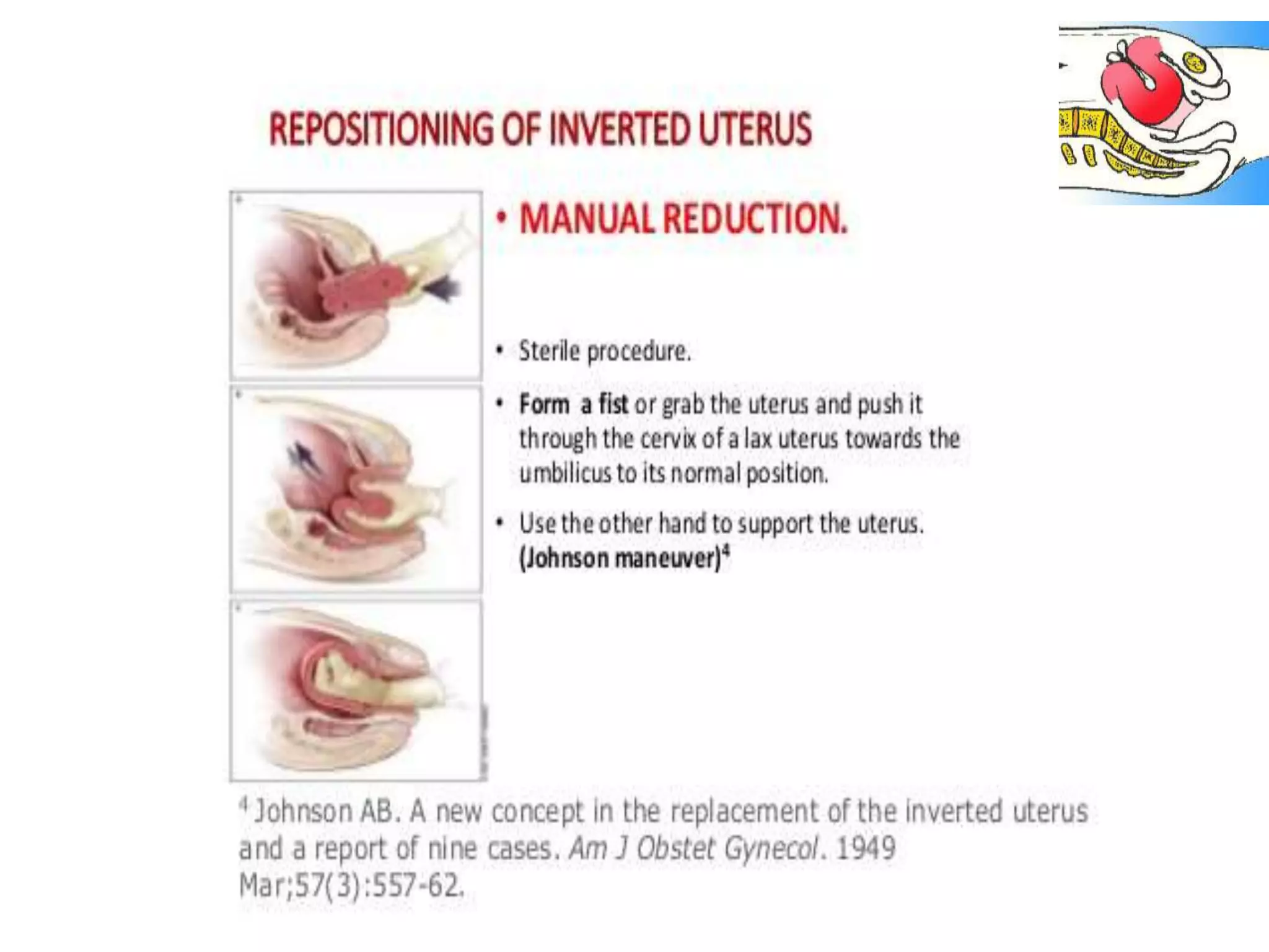 Inversion Of Uterus | PPTX