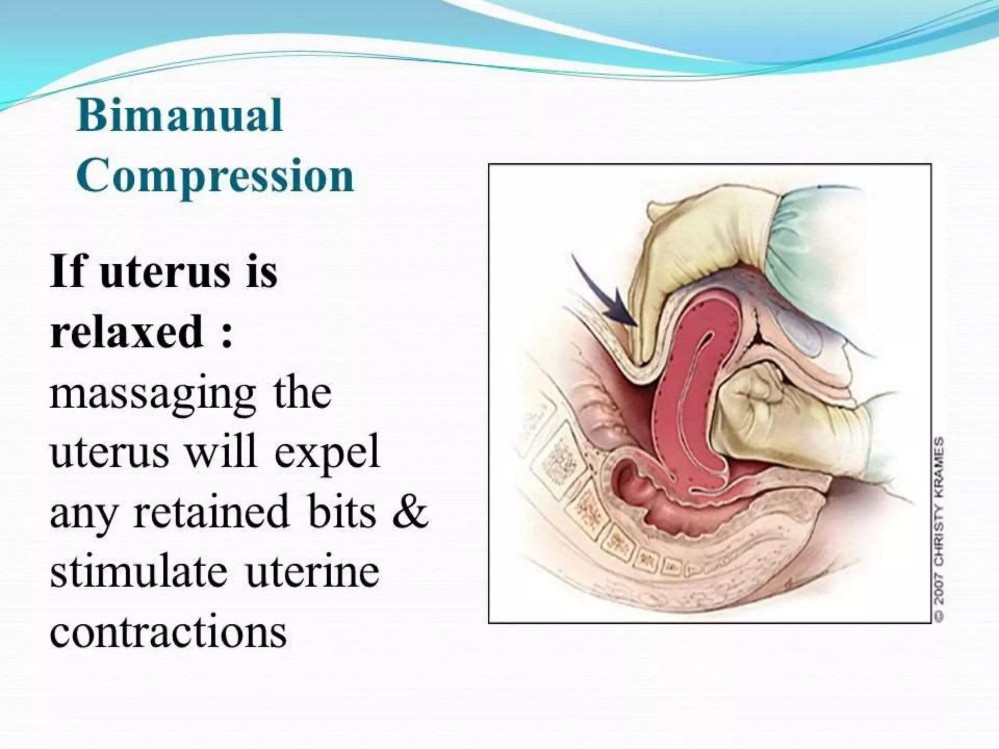 Inversion Of Uterus | PPTX