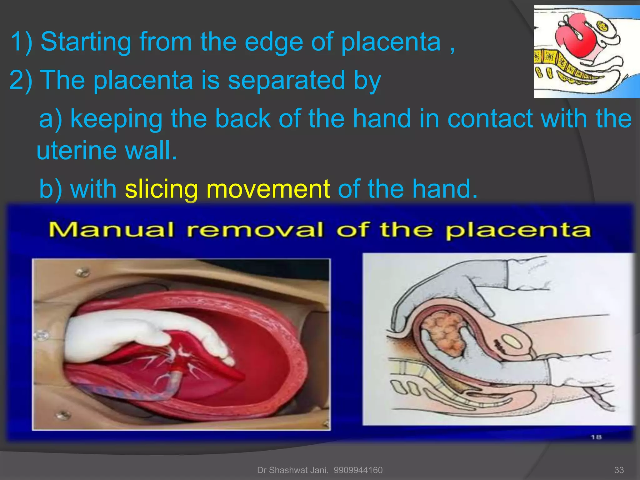 Inversion Of Uterus | PPTX
