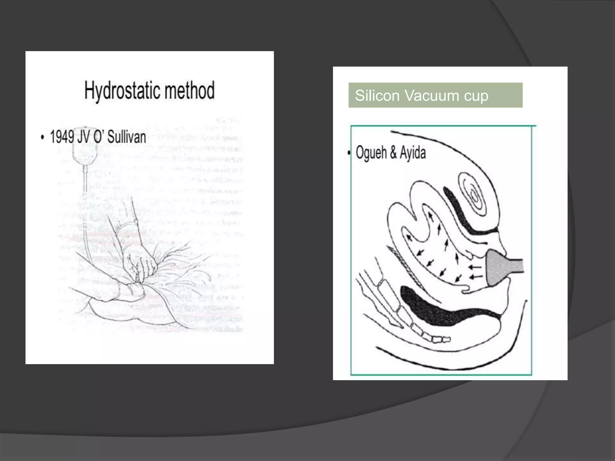 Inversion Of Uterus | PPTX