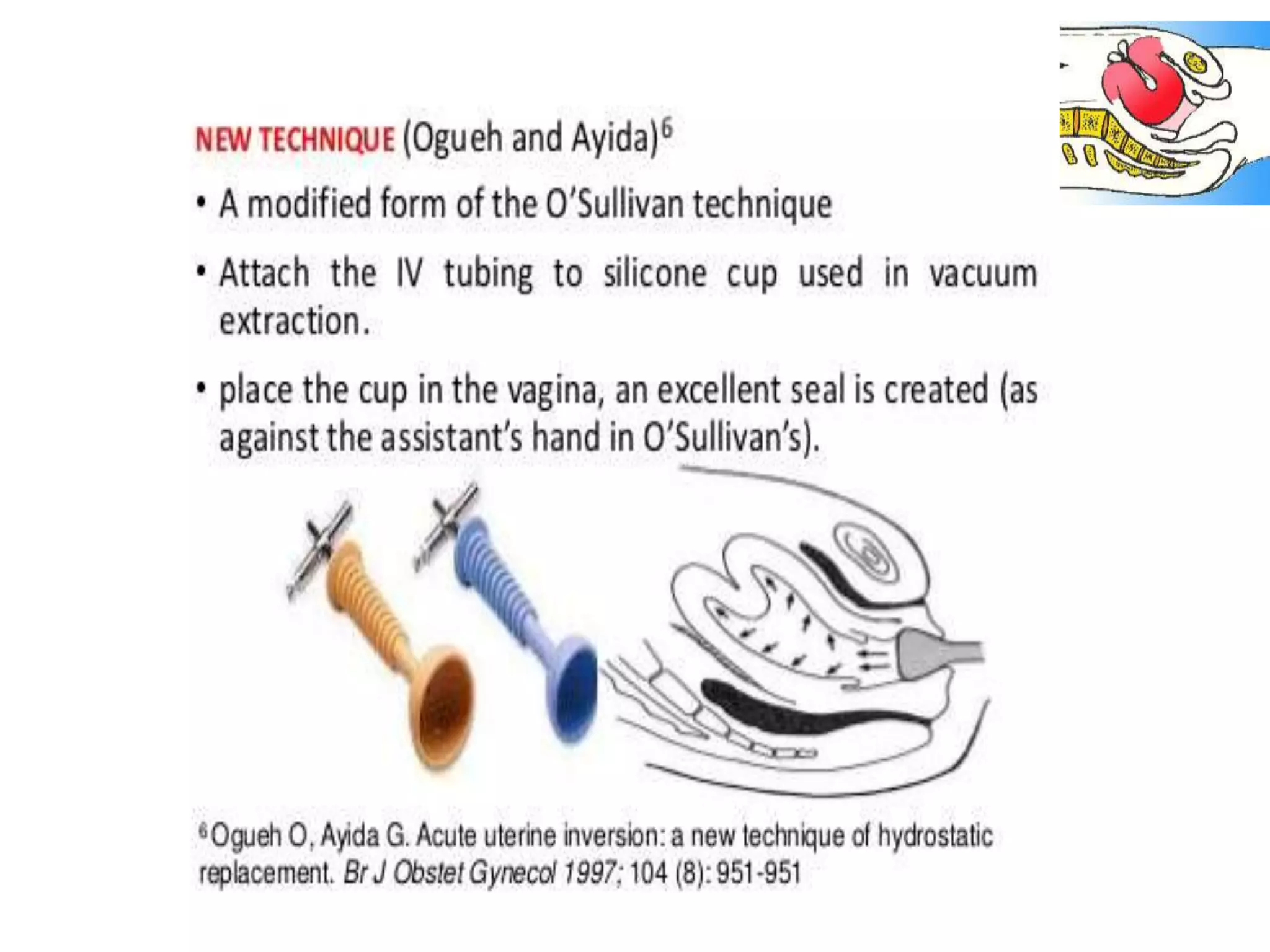 Inversion Of Uterus | PPTX