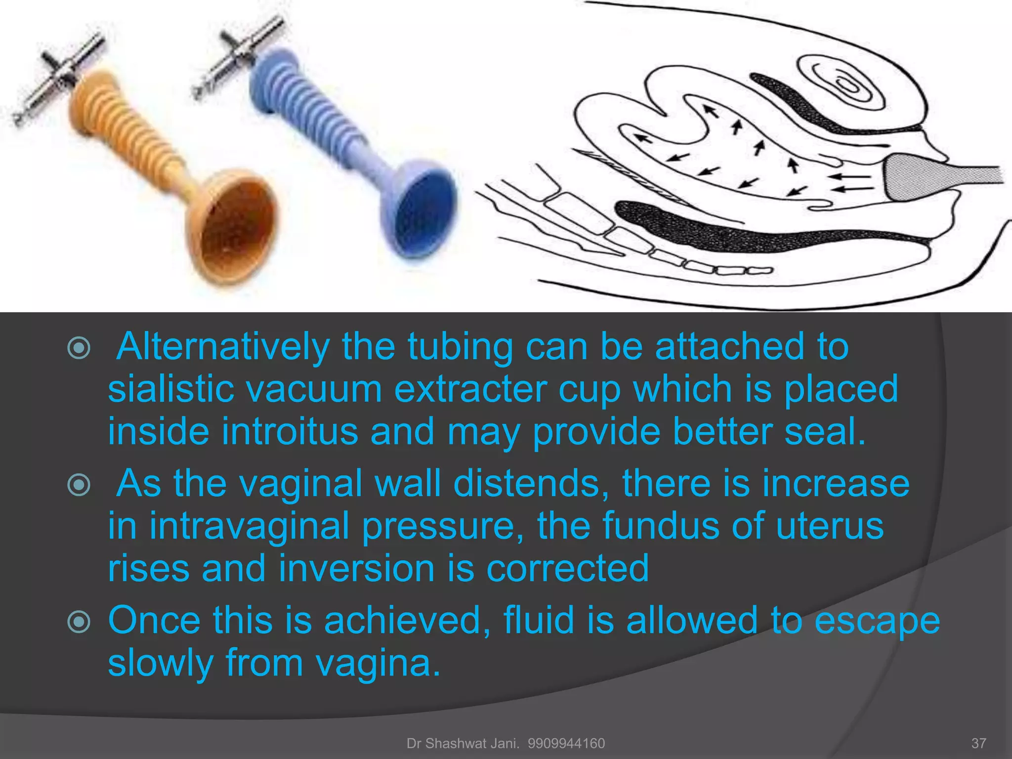 Inversion Of Uterus | PPTX