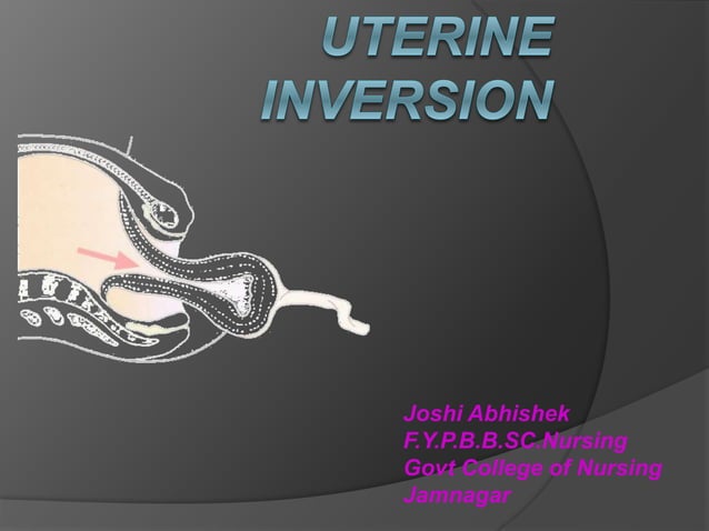 Inversion Of Uterus | PPTX | Pregnancy | Reproductive Health