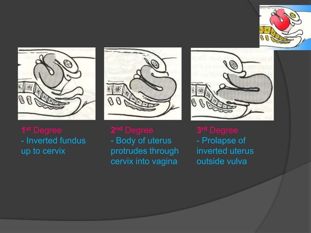 Inversion Of Uterus | PPTX | Pregnancy | Reproductive Health