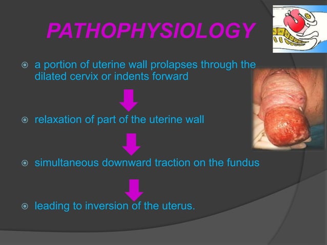 Inversion Of Uterus | PPT