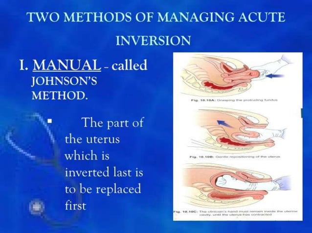 Inversion Of Uterus | PPTX | Pregnancy | Reproductive Health