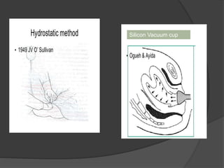Inversion Of Uterus | PPTX