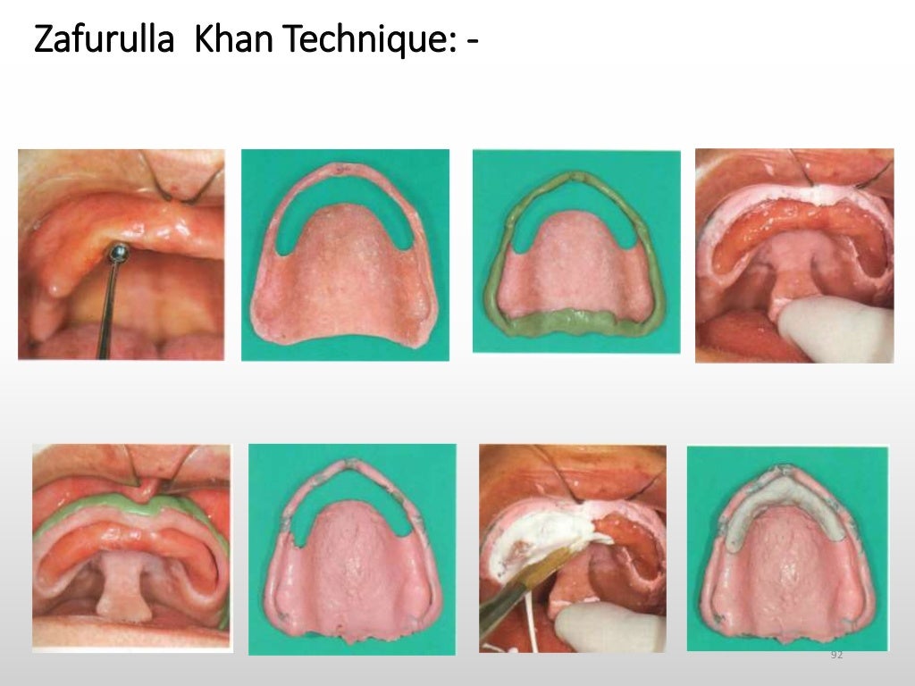 Negative impression dental - Flexteach