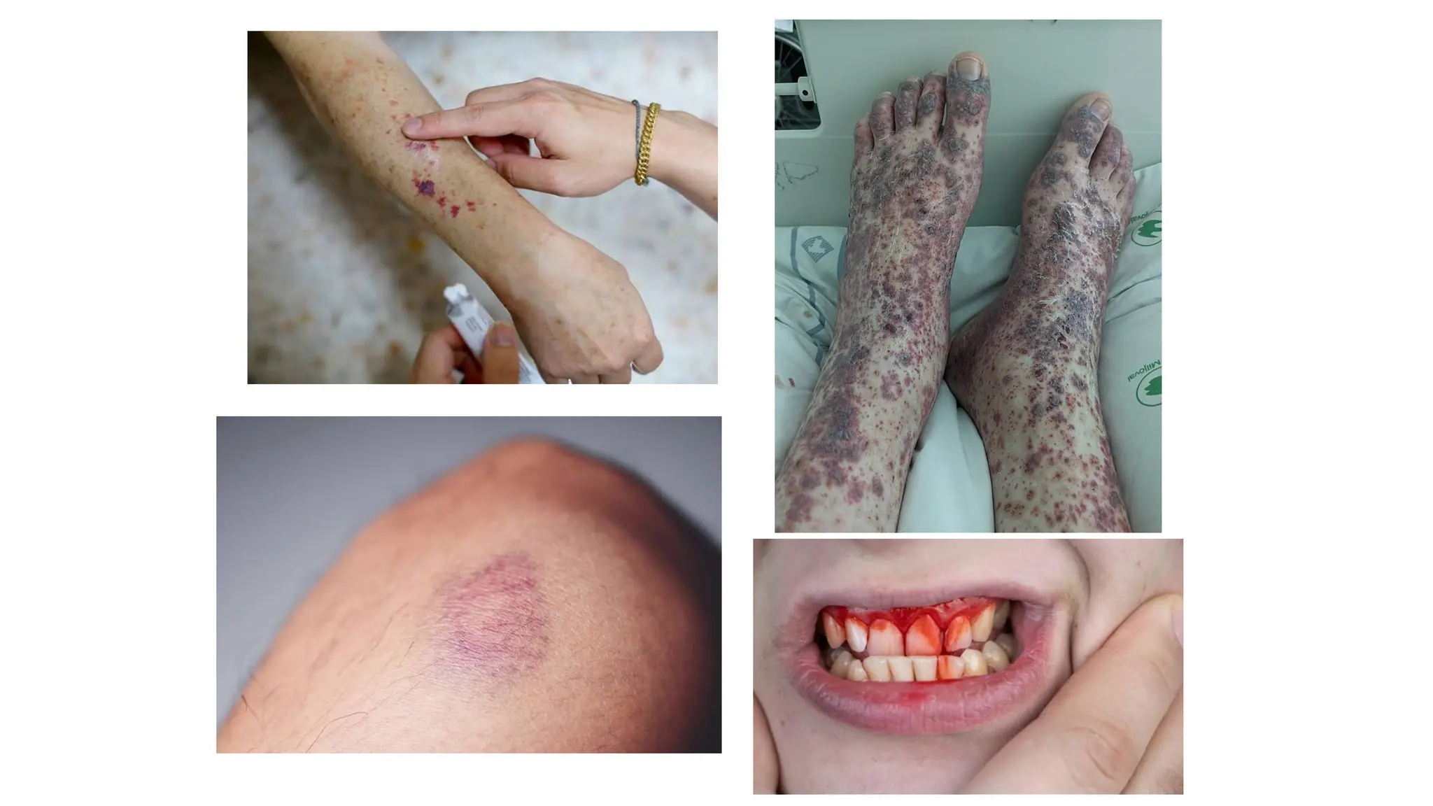 HEMOSTASIS COMPLETE part patho ppt (1).ppt