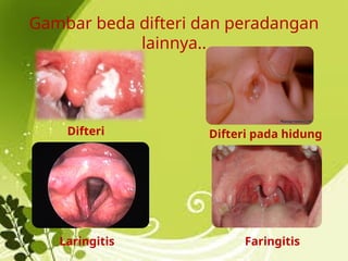 Penyakit Diphteri pada anak anak Ppt.pptx