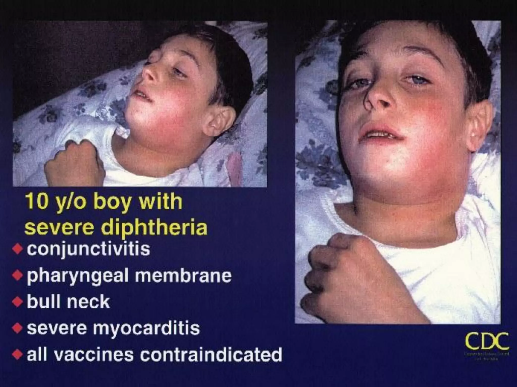 Diphtheria | PDF