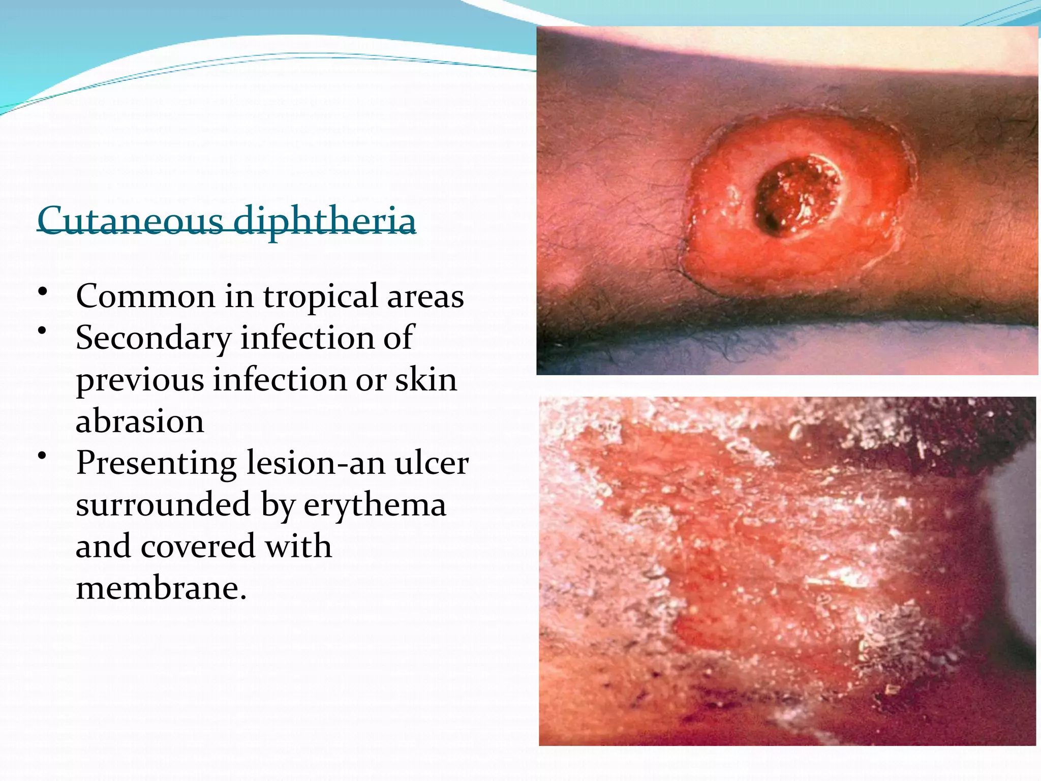 Diphtheria | PPTX