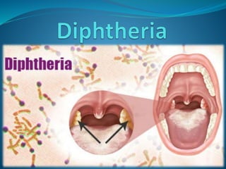 Diphtheria | PPTX | Infectious Diseases | Diseases and Conditions