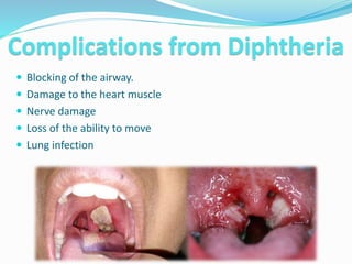 Diphtheria | PPTX