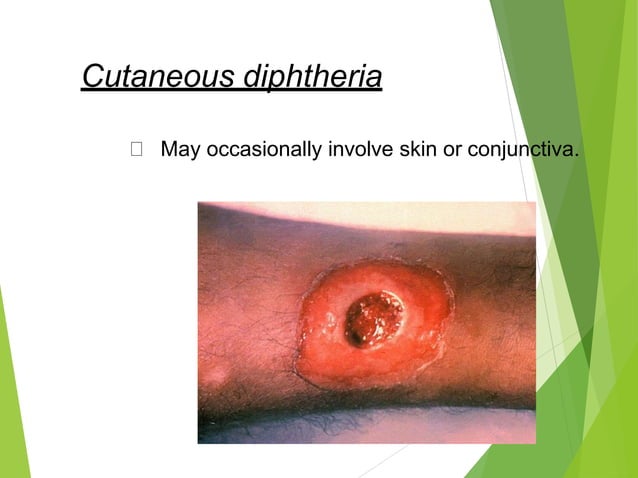 Diphtheria | PPTX