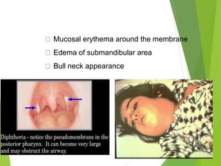 Diphtheria Bull Neck