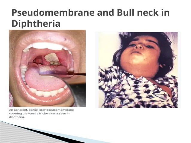 Diphtheria in Peadiatric by Akugizibwe Solomon(MBChB IV).pptx
