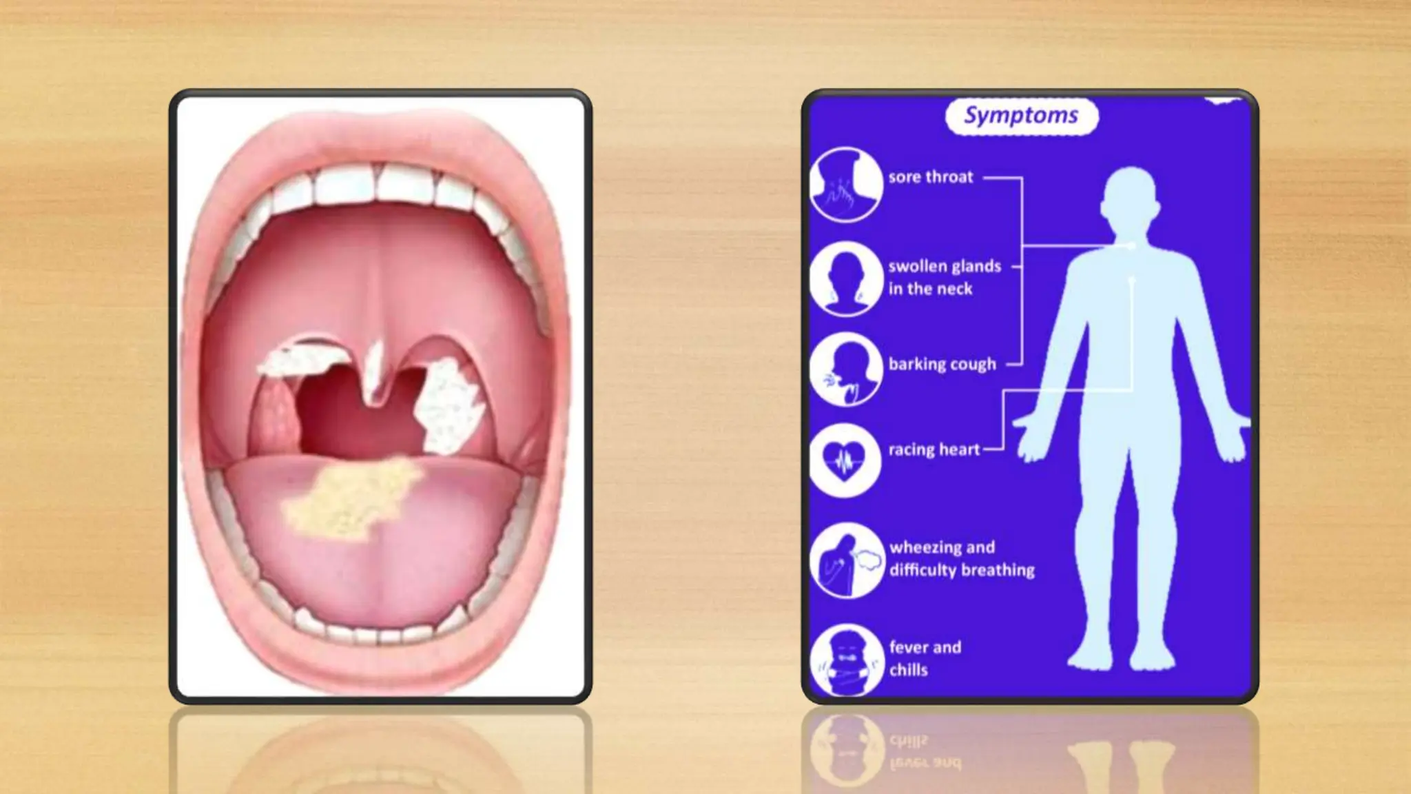 Diphtheria :- acute bacterial infection caused by Corynebacterium ...