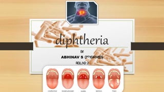 Diphtheria :- acute bacterial infection caused by Corynebacterium diphtheriae | PPTX