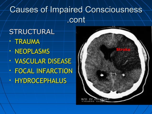 coma | PPT | Brain and Nervous System Disorders | Diseases and Conditions